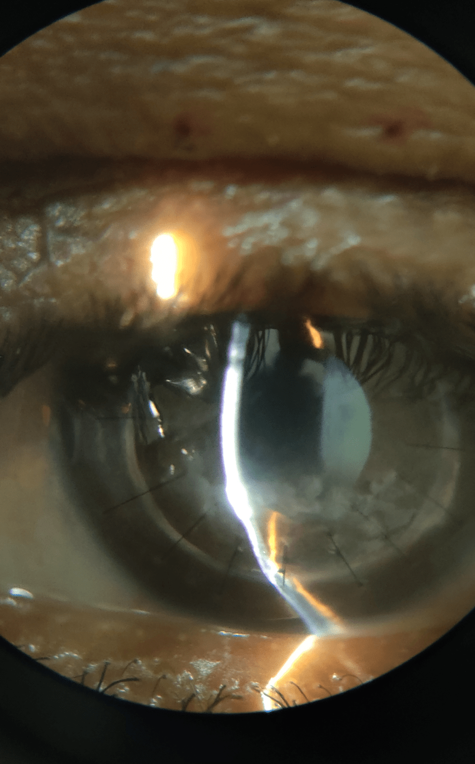 Keratoconus Symptoms & Treatment